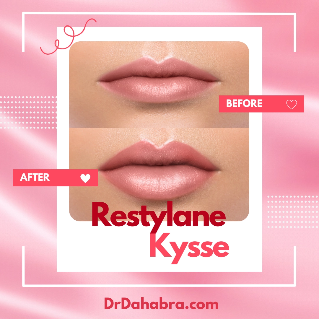 Coste de Restylane Kysse en Plantation Florida